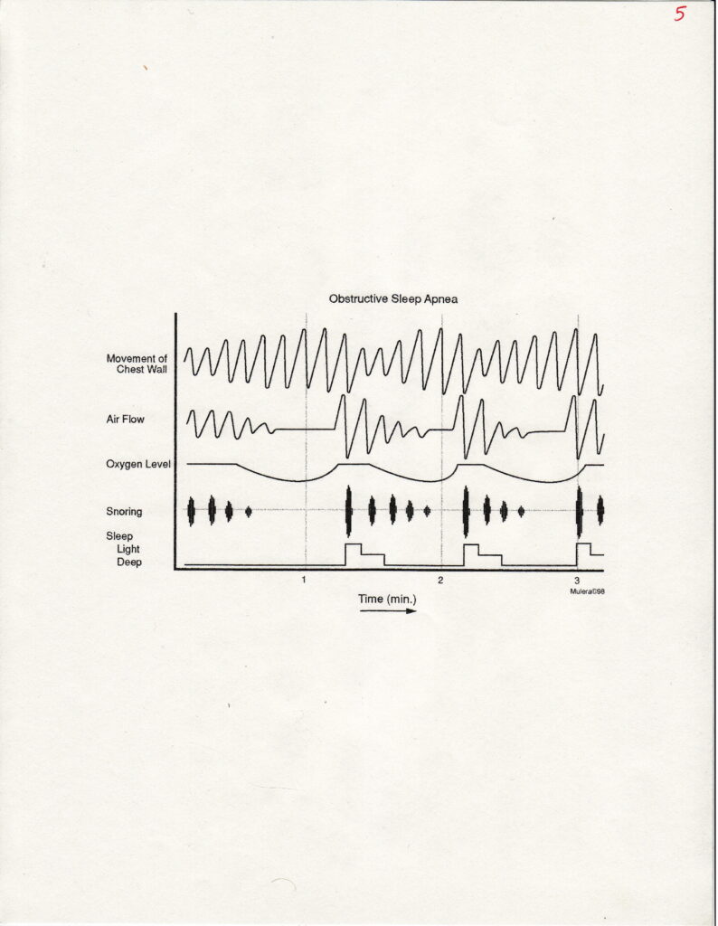 What is Obstructive Sleep Apnea | Sleep Inspirations
